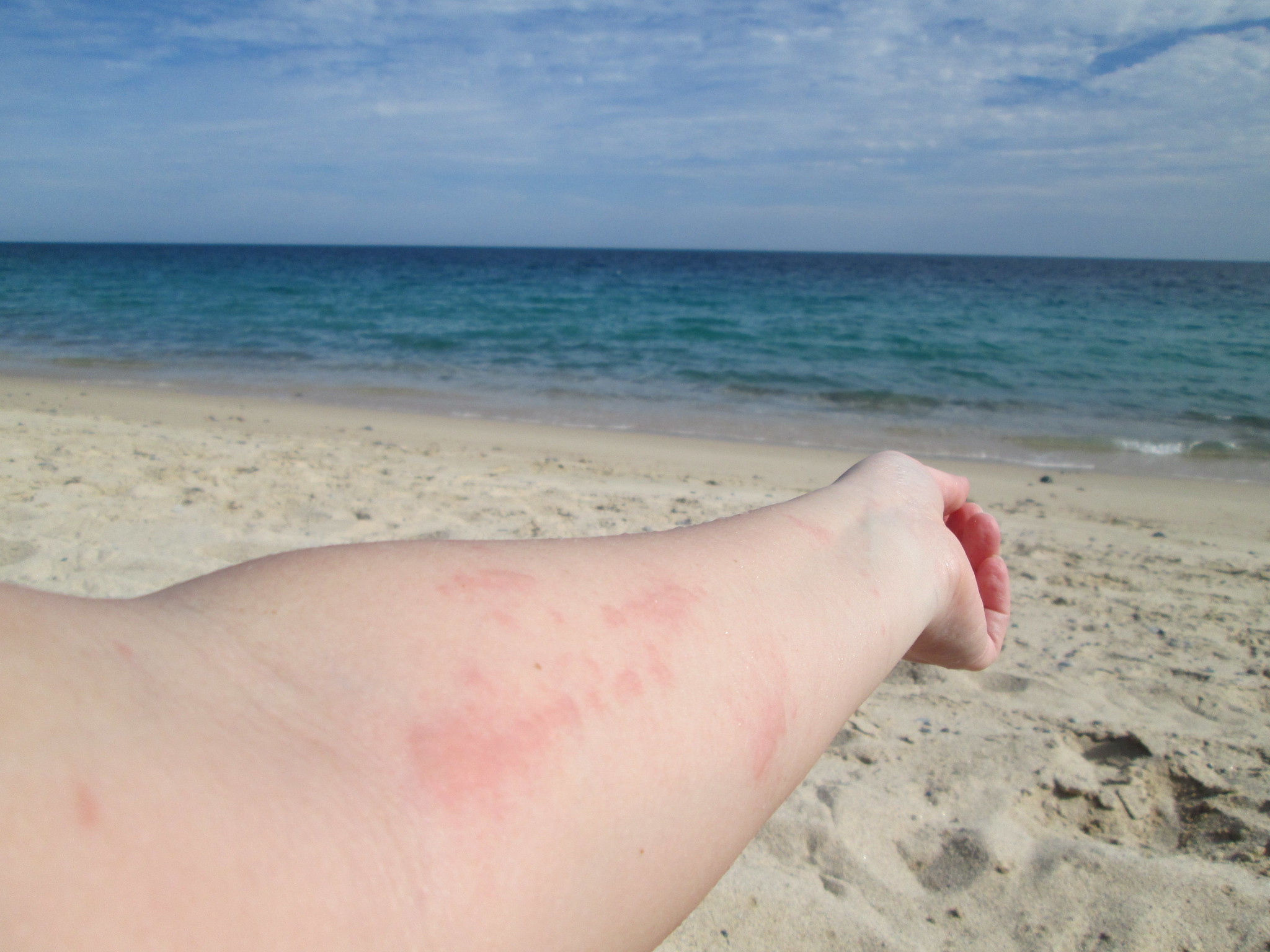 Beach Safety Tips: How To Avoid Being Bitten or Stung This Summer